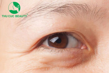 Cắt mắt 2 mí - Bệnh viện Thẩm mỹ Thu Cúc